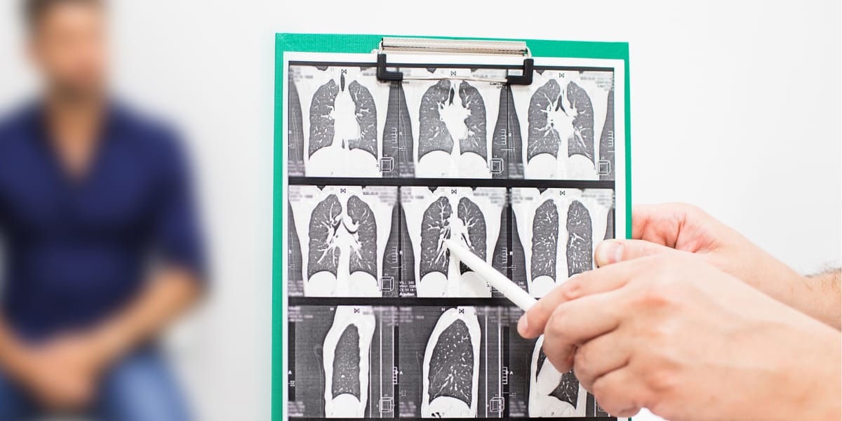 Longfibrose en Roken | Dit moet je er over weten [TIP]